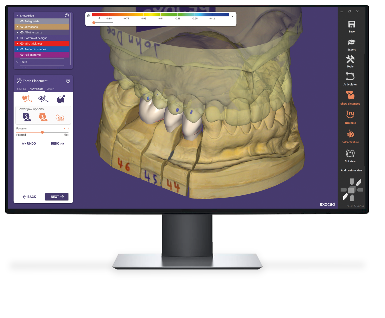 exocad DentalCAD | XYZ Dental