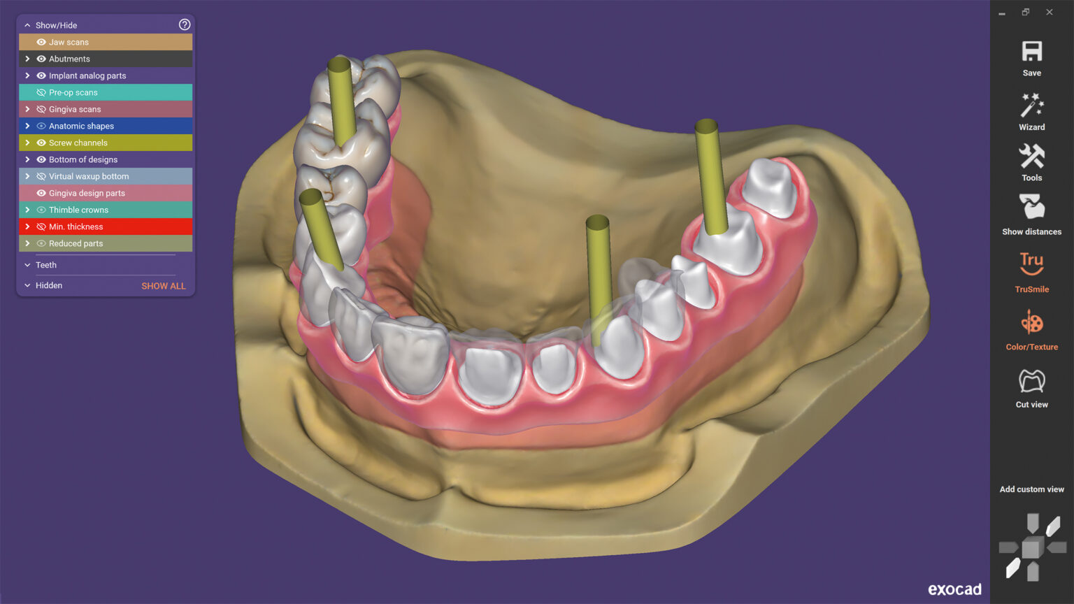 Exocad DentalCAD Licences | XYZ Dental