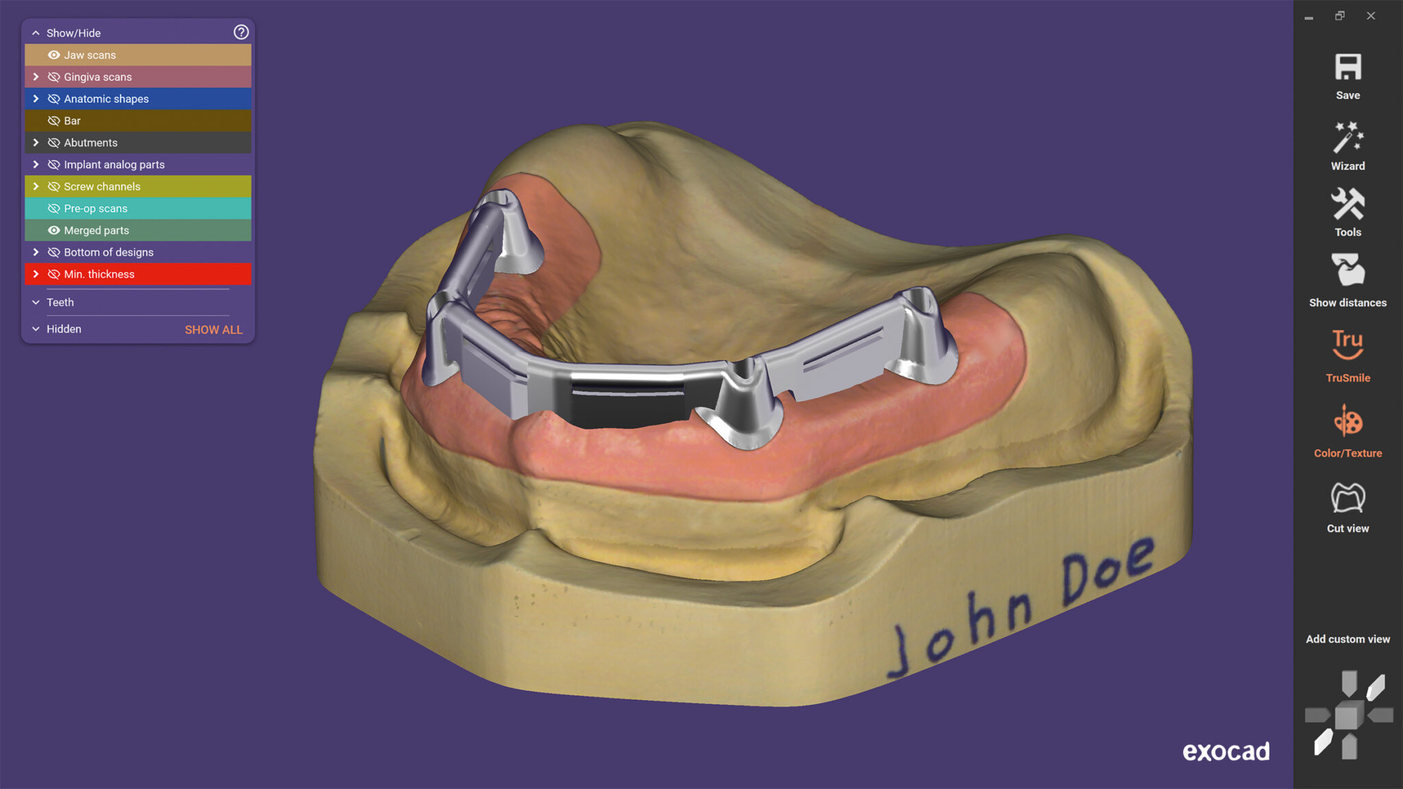 Exocad DentalCAD Add-On Modules | XYZ Dental
