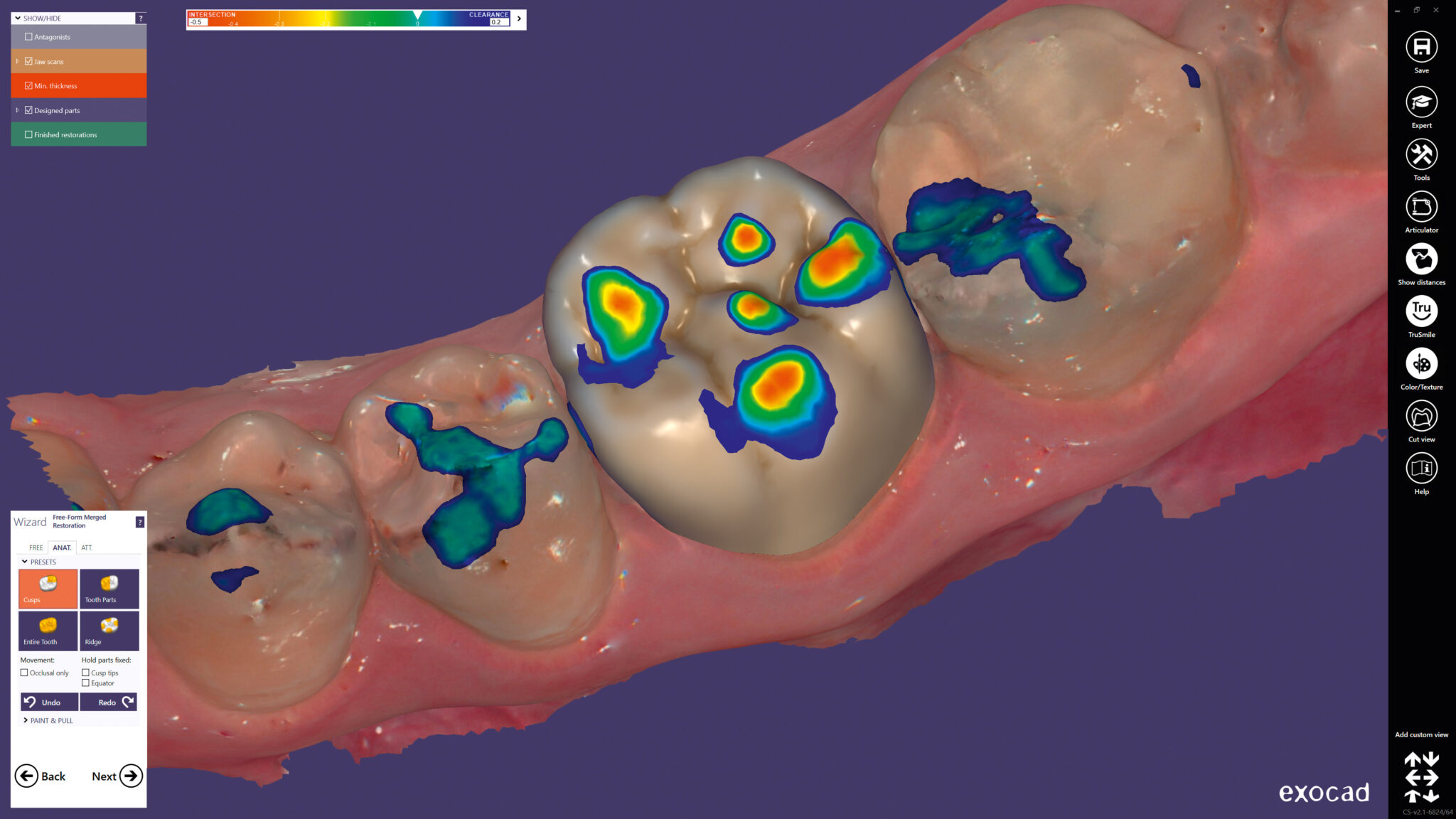 Exocad ChairsideCAD Add-On Modules | XYZ Dental